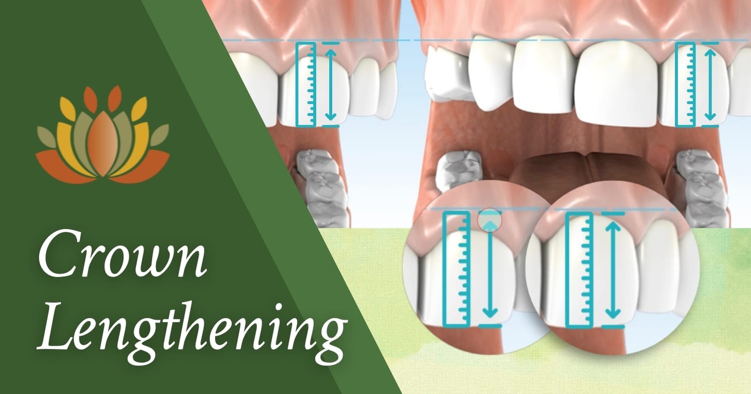 Crown Lengthening — La Jolla, Chula Vista