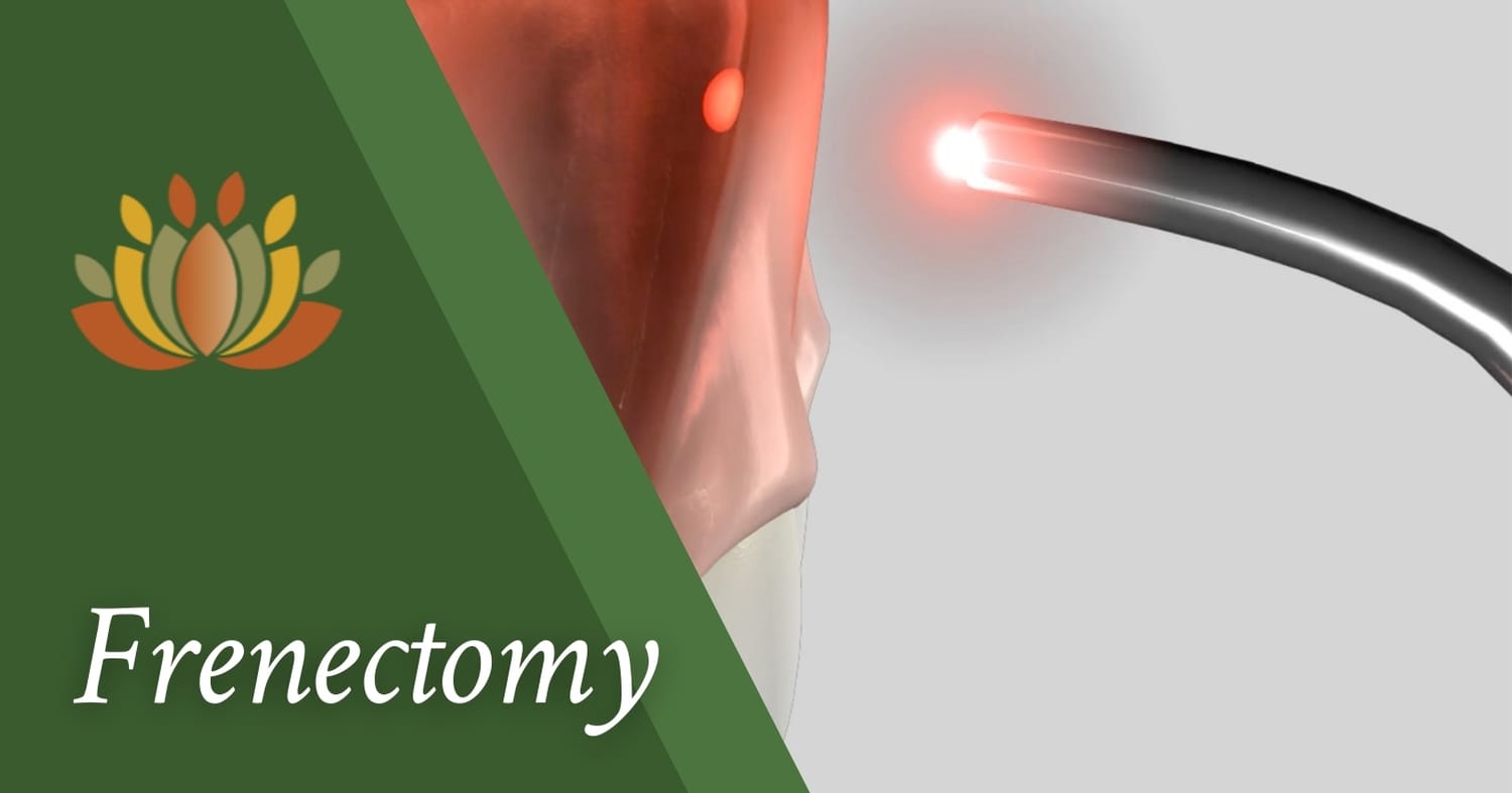 Frenectomy — La Jolla, Chula Vista