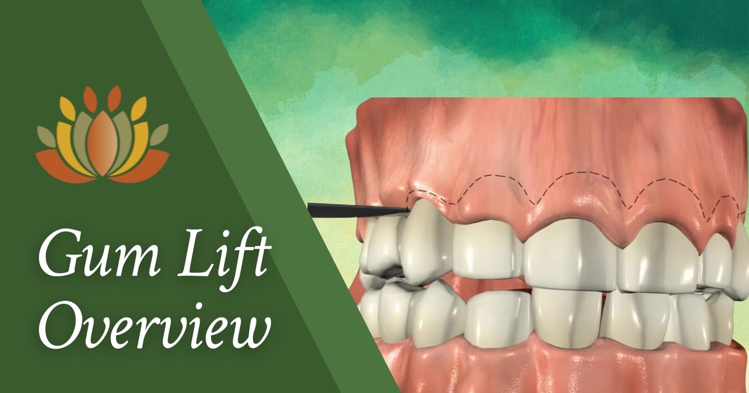 Gum Lift — La Jolla, Chula Vista