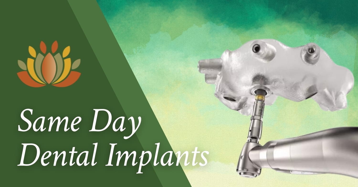Same-Day Dental Implants — La Jolla, Chula Vista