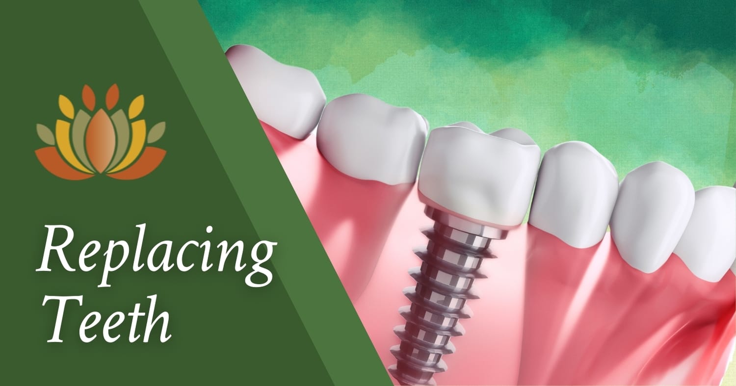 Options for Replacing Teeth — La Jolla, Chula Vista