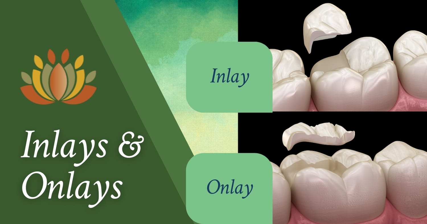 Inlay, Onlay — Life Smiles Dental Care